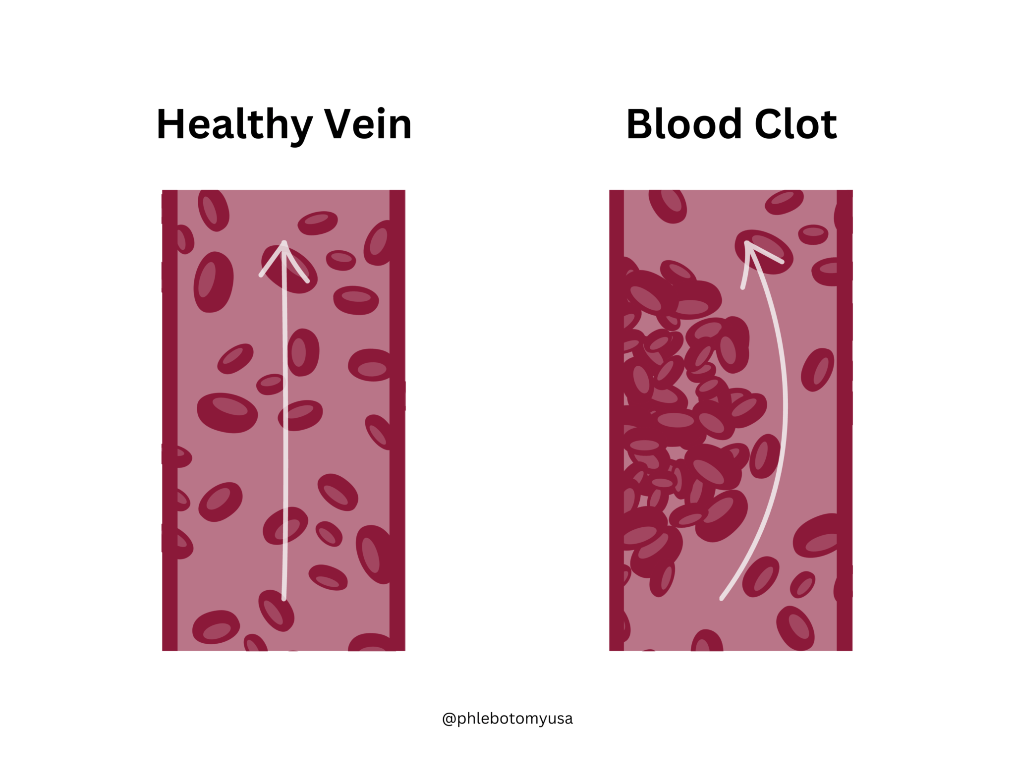 Debunking 8 Myths About Blood Clots - Phlebotomy USA
