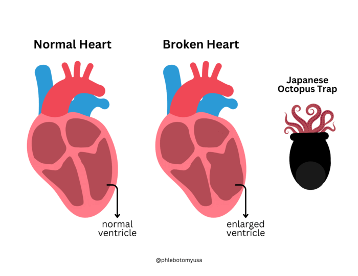 Yes, You Can Die of A Broken Heart - Phlebotomy USA